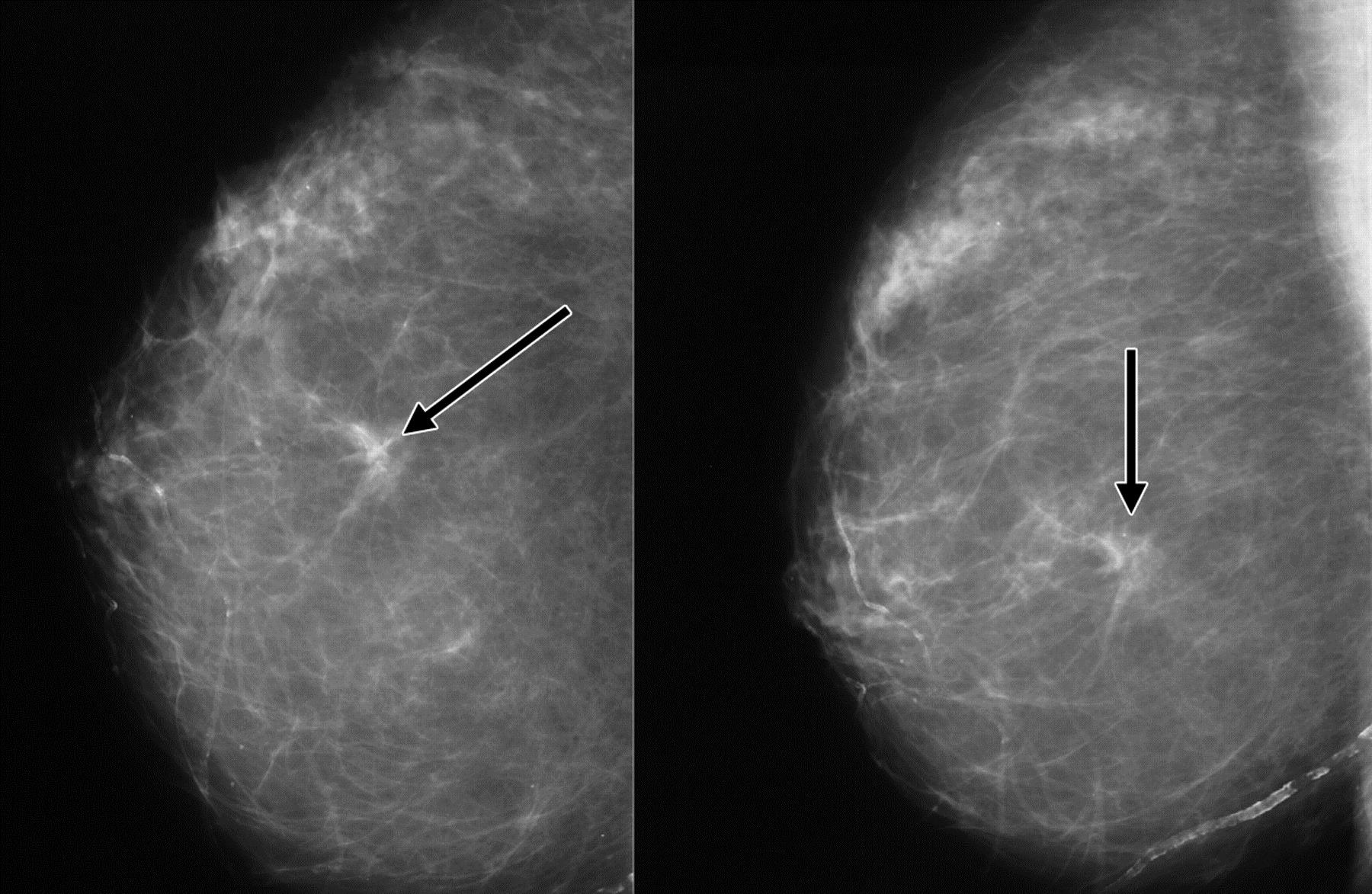 3 Facts About Breast Cancer Screening Every Woman Needs To Know El 3-facts-about-breast-cancer-screening-every-woman-needs-to-know-el